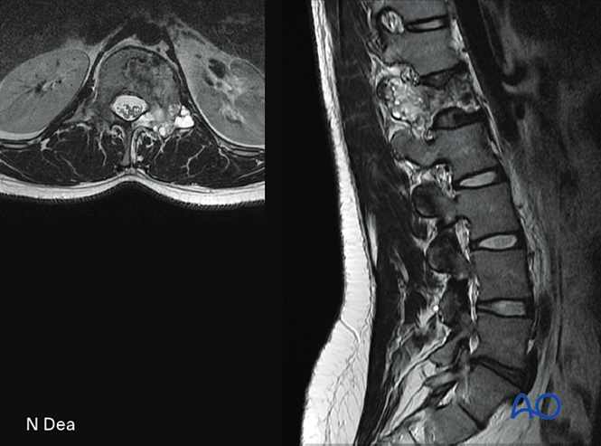 Intralesional resection (L1 to L5) for Benign lumbar tumors