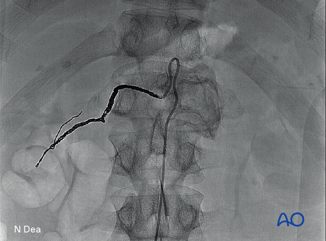 En bloc resection with posterior release and anterior tumor delivery ...