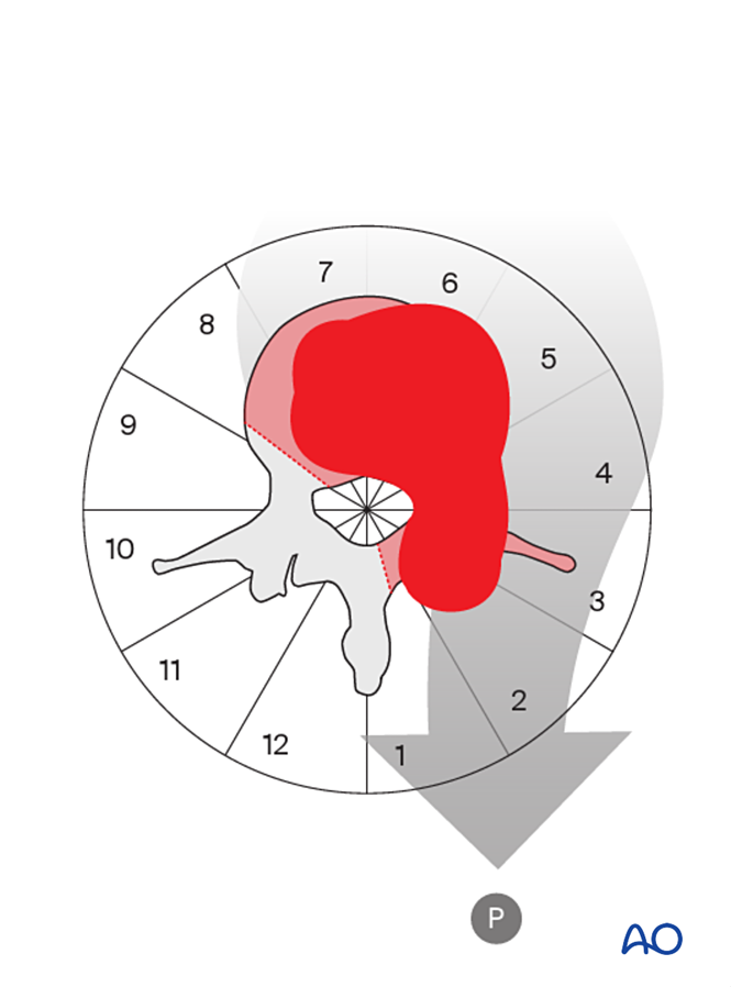 Intralesional resection (L1 to L5) for Benign lumbar tumors