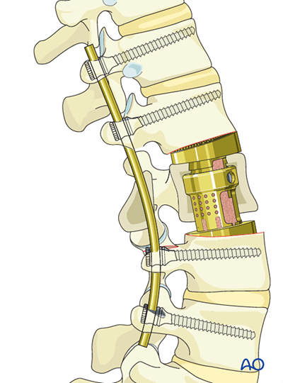 Intralesional resection (L1 to L5) for Benign lumbar tumors