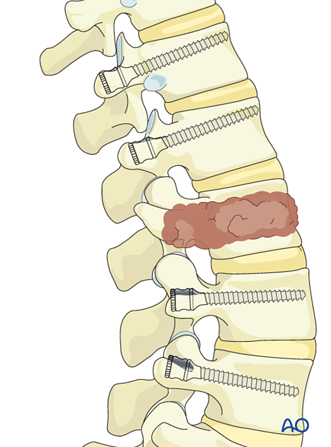 Intralesional resection (L1 to L5) for Benign lumbar tumors