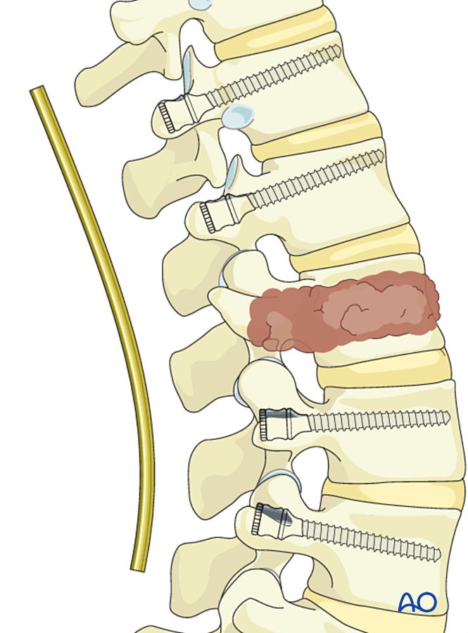 Intralesional resection (L1 to L5) for Benign lumbar tumors