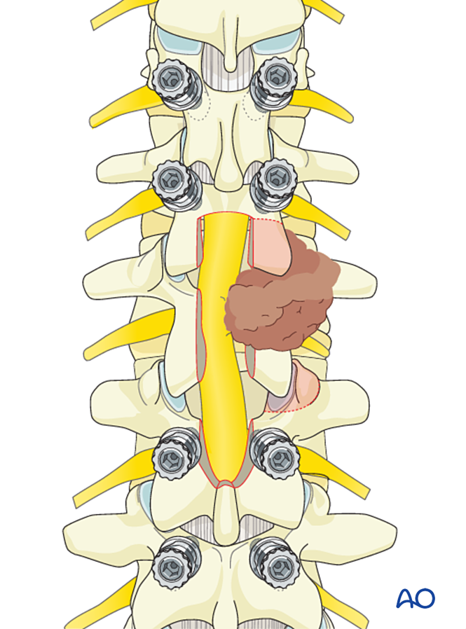 Intralesional resection (L1 to L5) for Benign lumbar tumors