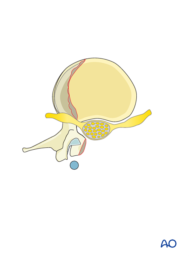 Intralesional resection (L1 to L5) for Benign lumbar tumors