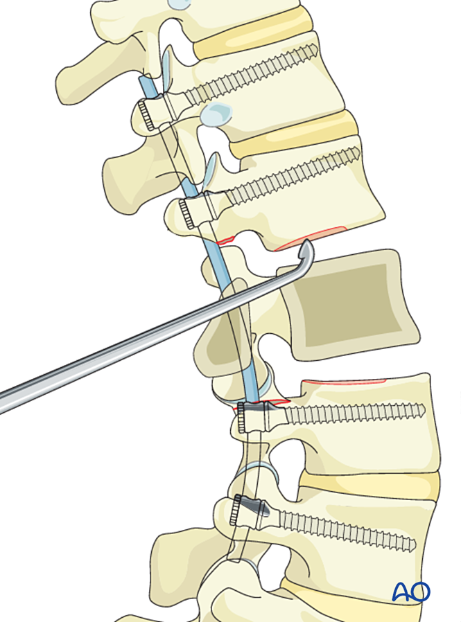 Intralesional resection (L1 to L5) for Benign lumbar tumors