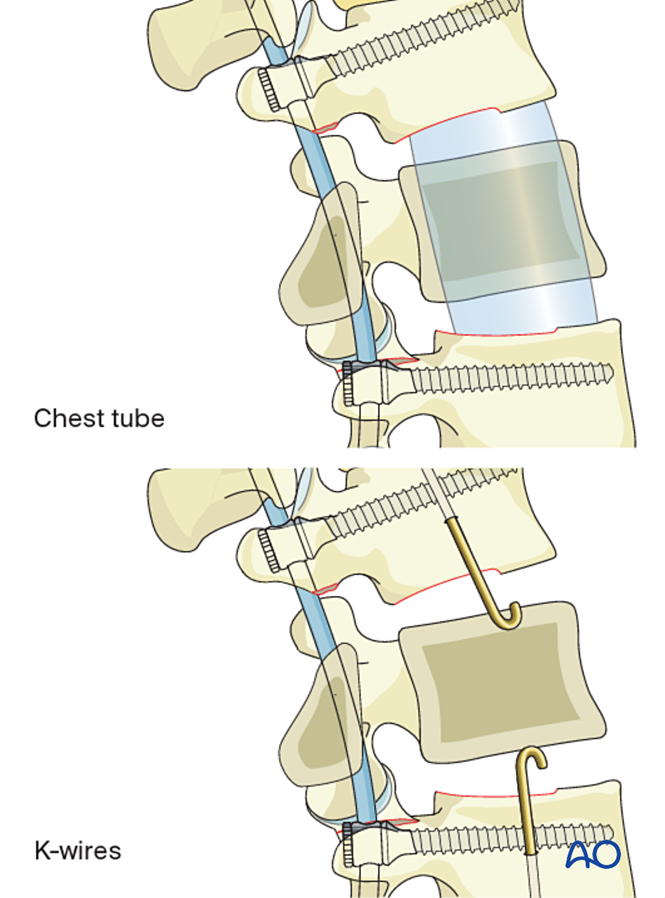 Intralesional resection (L1 to L5) for Benign lumbar tumors