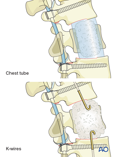 Intralesional resection (L1 to L5) for Benign lumbar tumors