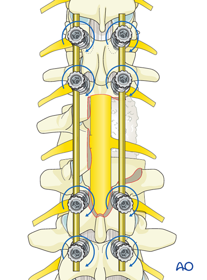 Intralesional resection (L1 to L5) for Benign lumbar tumors