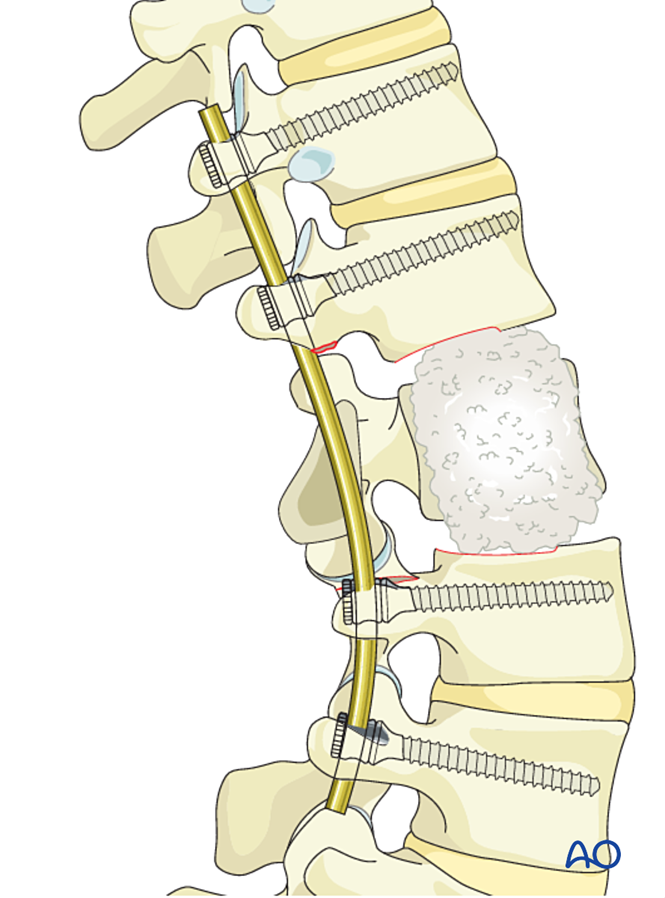 Intralesional resection (L1 to L5) for Benign lumbar tumors