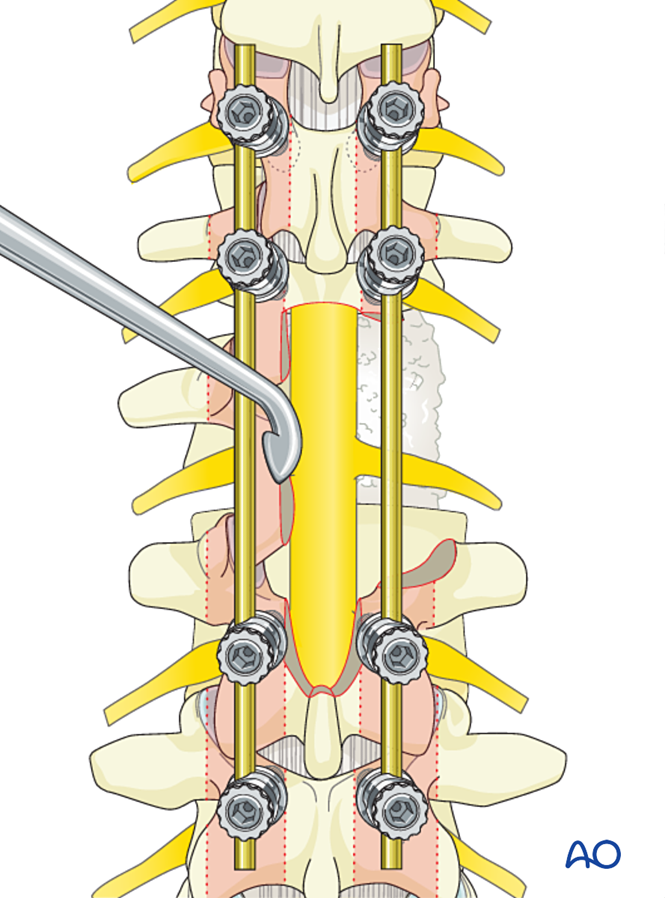 Intralesional resection (L1 to L5) for Benign lumbar tumors