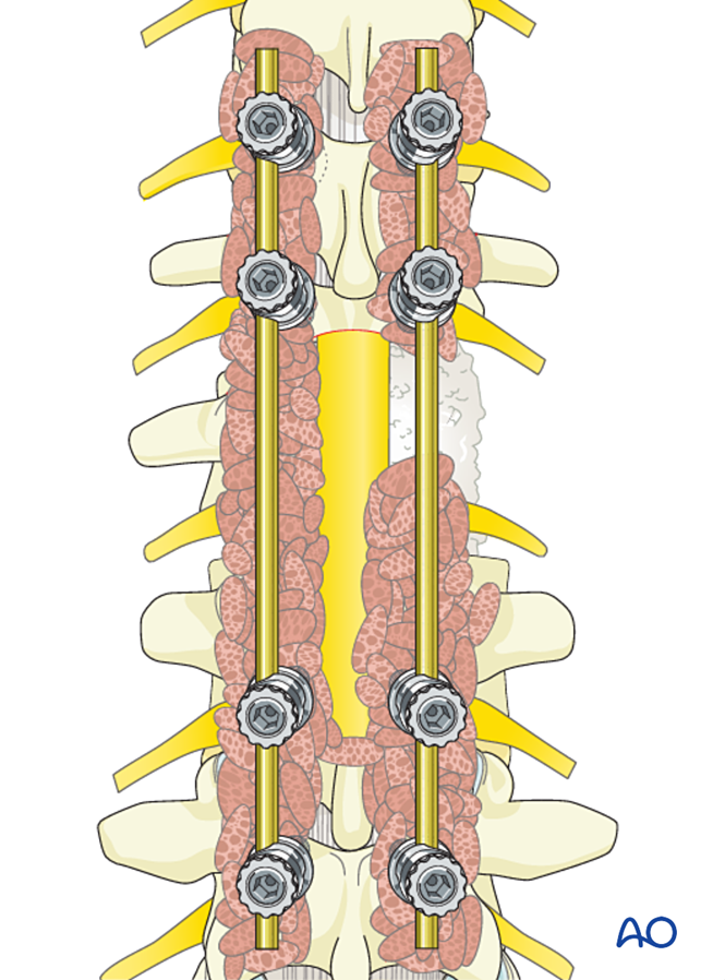 Intralesional resection (L1 to L5) for Benign lumbar tumors