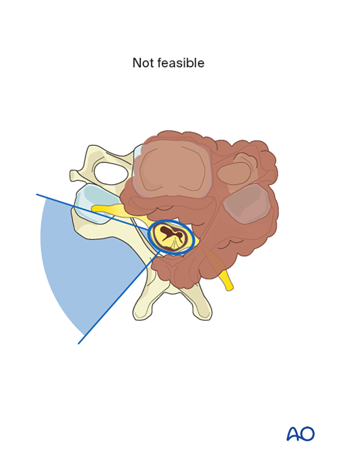 En bloc resection of an anterior tumor (C1 to C7) for Benign cervical ...