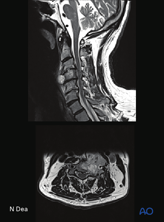 En bloc resection of an anterior tumor (C1 to C7) for Benign cervical ...