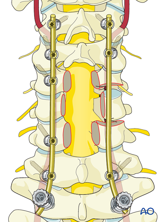 En bloc resection of an anterior tumor (C1 to C7) for Benign cervical ...