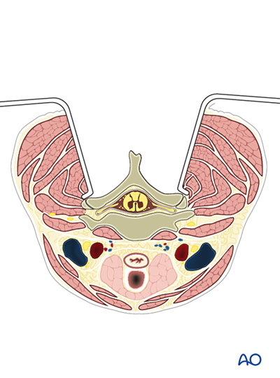 En bloc resection of an anterior tumor (C1 to C7) for Malignant ...