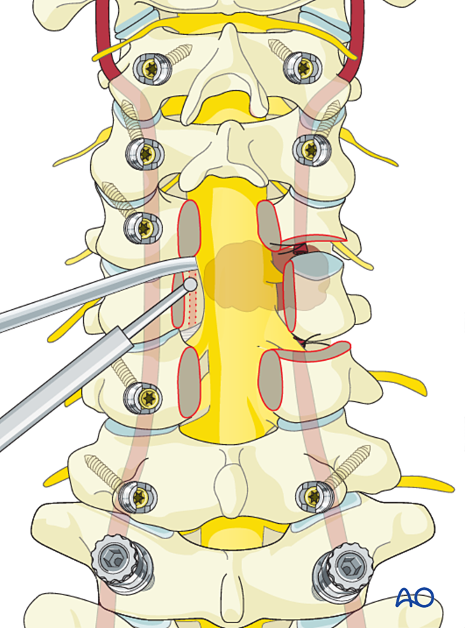 En bloc resection of an anterior tumor (C1 to C7) for Benign cervical ...
