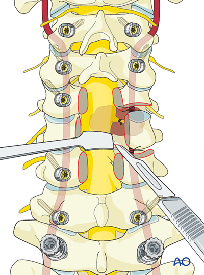 En bloc resection of an anterior tumor (C1 to C7) for Benign cervical ...