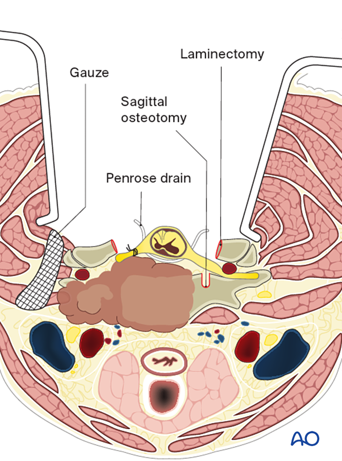 En bloc resection of an anterior tumor (C1 to C7) for Malignant ...