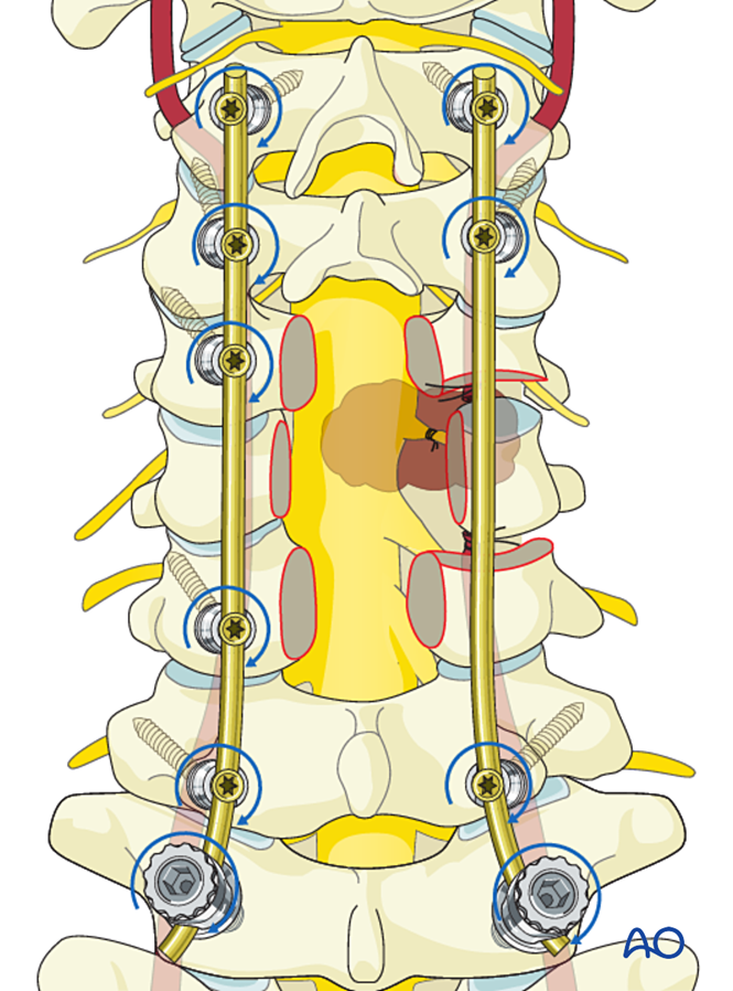 En bloc resection of an anterior tumor (C1 to C7) for Benign cervical ...