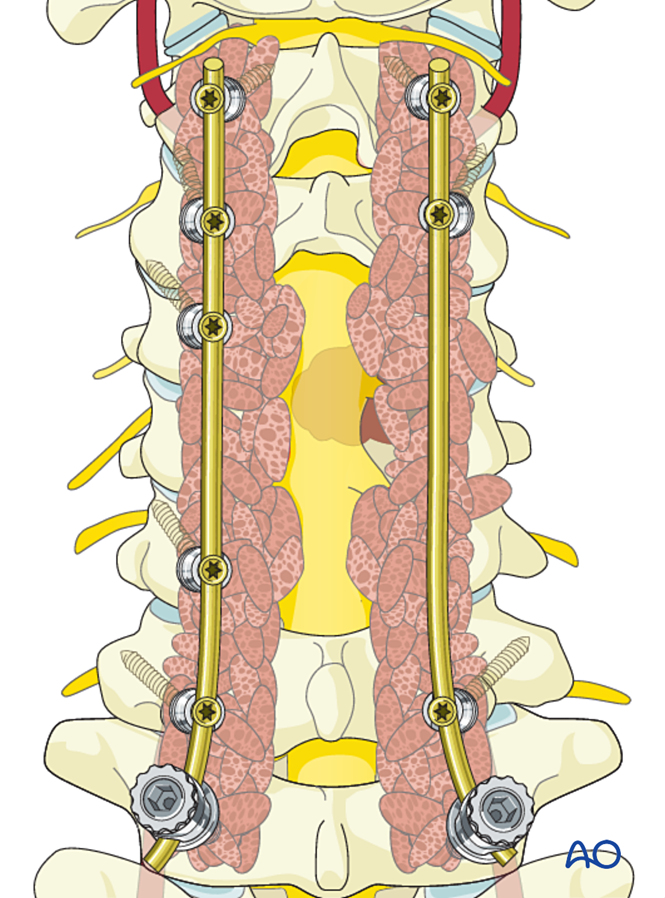 En bloc resection of an anterior tumor (C1 to C7) for Benign cervical ...