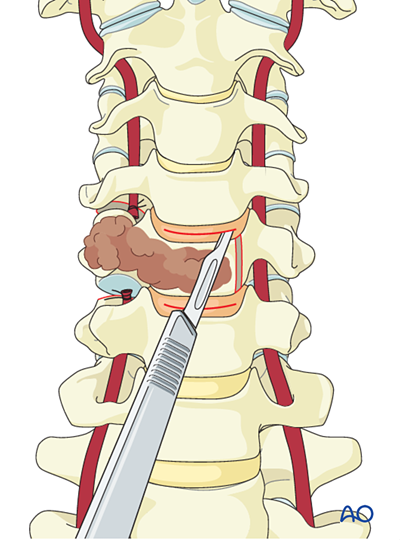 En bloc resection of an anterior tumor (C1 to C7) for Benign cervical ...