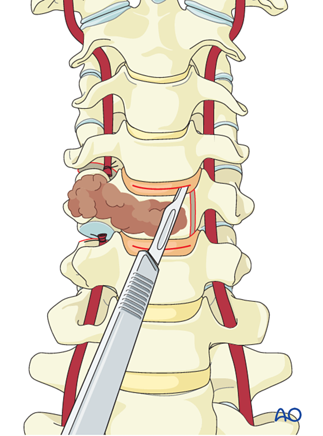 En bloc resection of an anterior tumor (C1 to C7) for Benign cervical ...