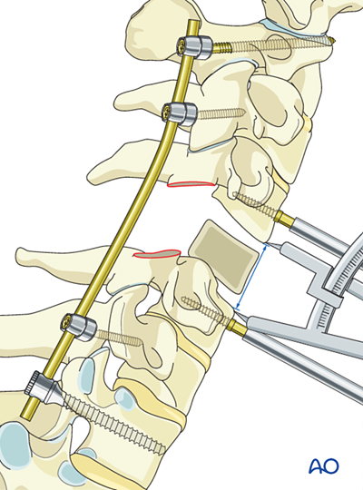 En bloc resection of an anterior tumor (C1 to C7) for Benign cervical ...