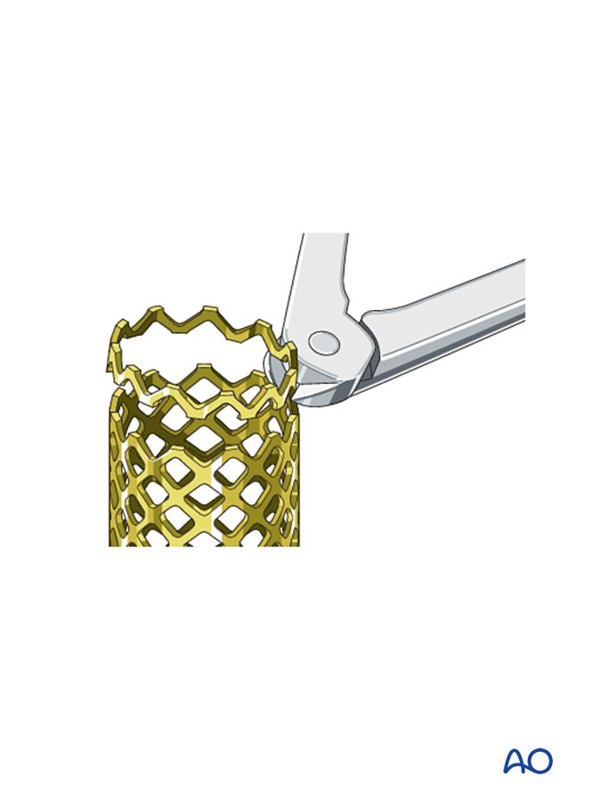 En bloc resection of an anterior tumor (C1 to C7) for Benign cervical ...