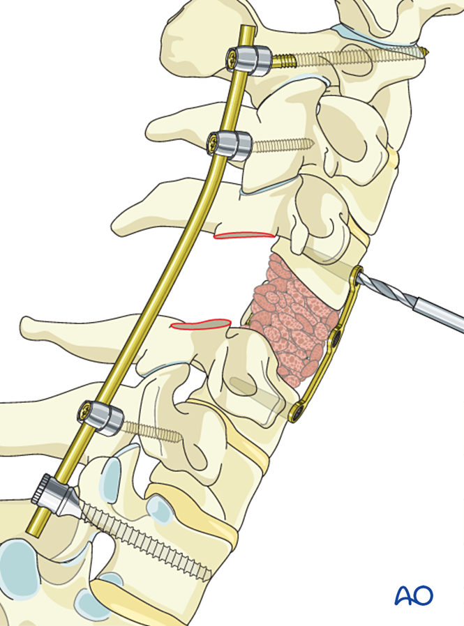 En bloc resection of an anterior tumor (C1–C7) for Malignant cervical ...