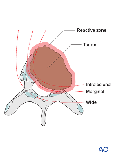 En bloc resection of an anterior tumor (T1 to T12) for Malignant ...