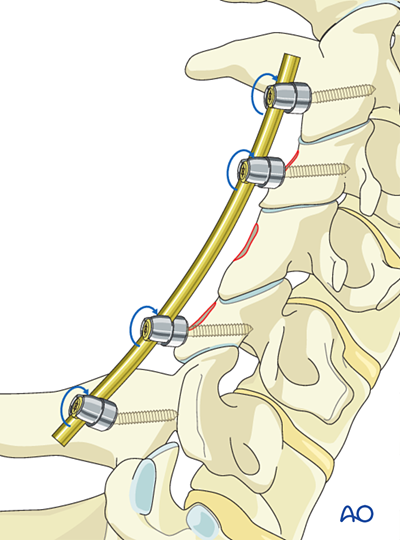 En bloc resection of a posterior tumor (C1 to C7) for Benign cervical ...