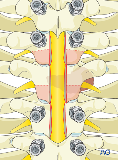 En bloc resection of an anterior tumor (T1 to T12) for Malignant ...