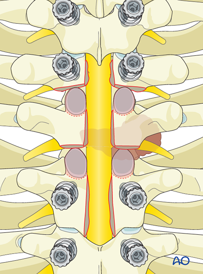 En bloc resection of an anterior tumor (T1 to T12) for Malignant ...