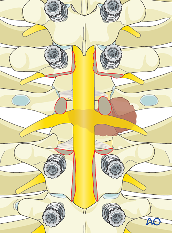 En bloc resection of an anterior tumor (T1 to T12) for Malignant ...