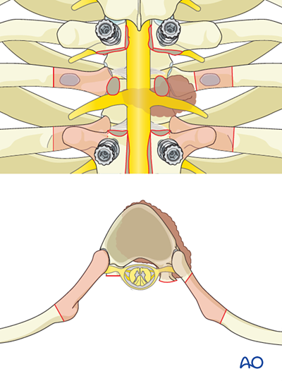 En bloc resection of an anterior tumor (T1 to T12) for Malignant ...