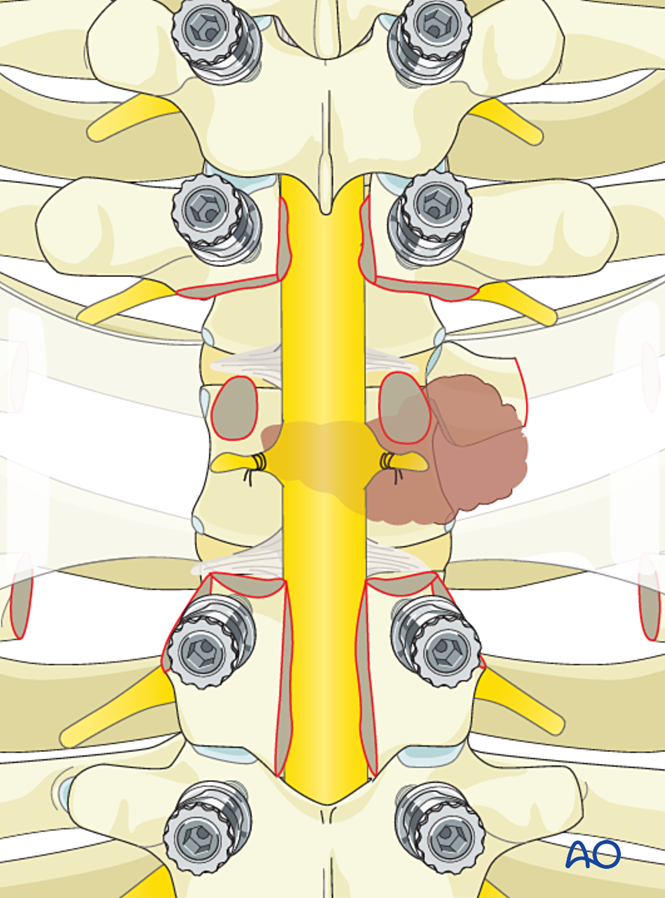 En bloc resection of an anterior tumor (T1 to T12) for Malignant ...