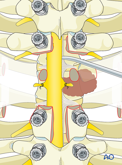 En bloc resection of an anterior tumor (T1 to T12) for Malignant ...