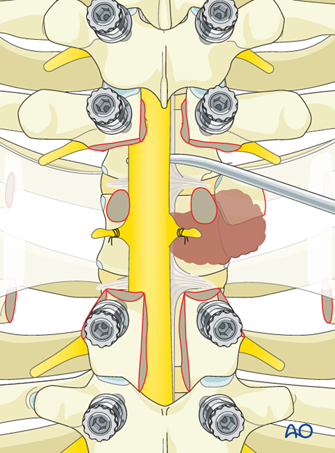 En bloc resection of an anterior tumor (T1 to T12) for Malignant ...