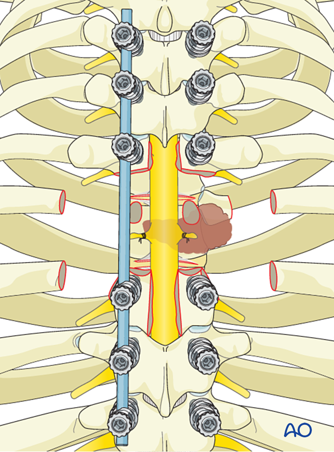 En bloc resection of an anterior tumor (T1 to T12) for Benign thoracic ...