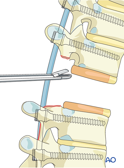 En bloc resection of an anterior tumor (T1 to T12) for Malignant ...