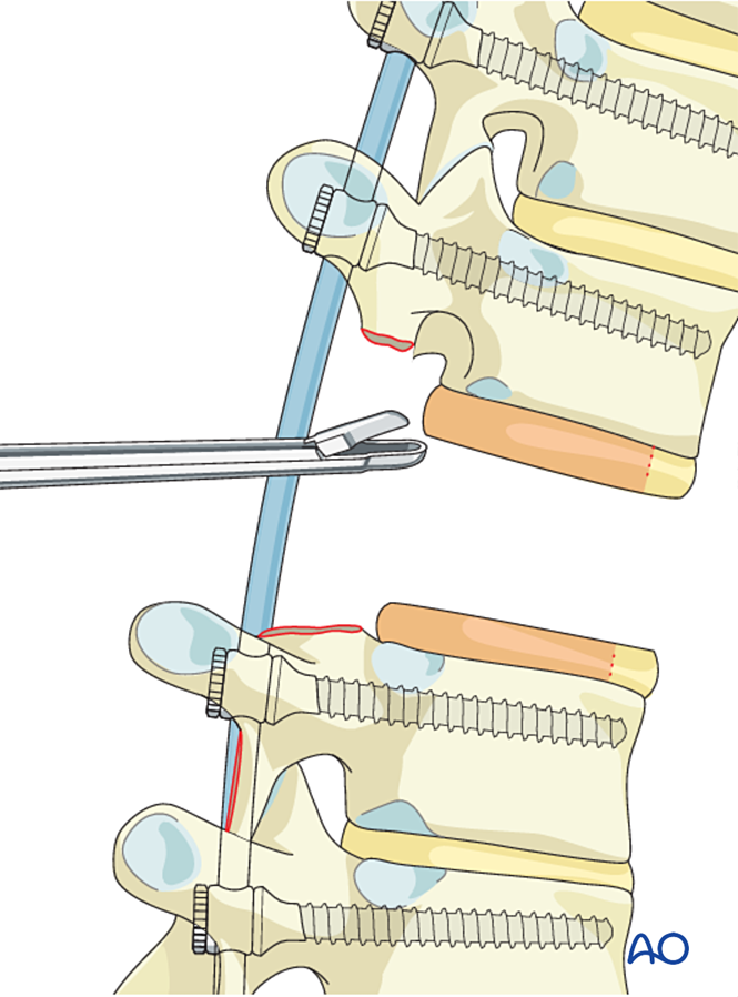 En bloc resection of an anterior tumor (T1 to T12) for Malignant ...