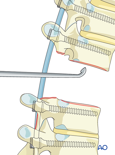 En bloc resection of an anterior tumor (T1 to T12) for Malignant ...