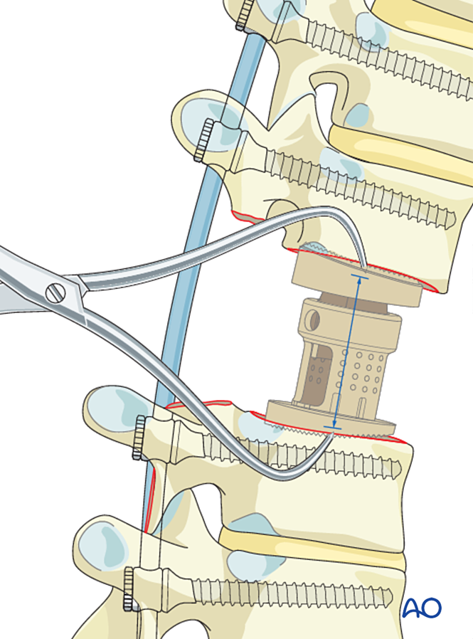 En bloc resection of an anterior tumor (T1 to T12) for Malignant ...
