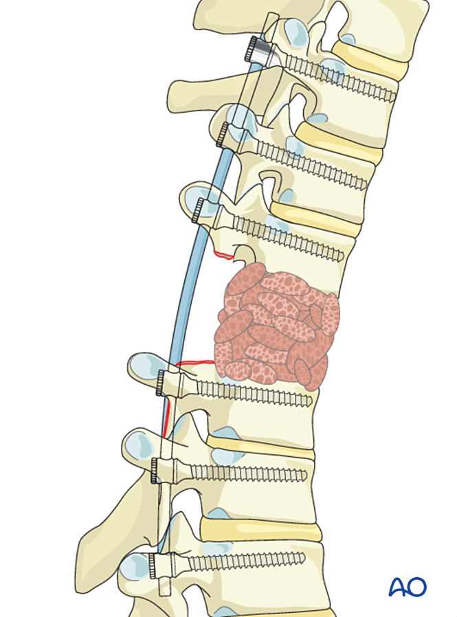 En bloc resection of an anterior tumor (T1 to T12) for Malignant ...