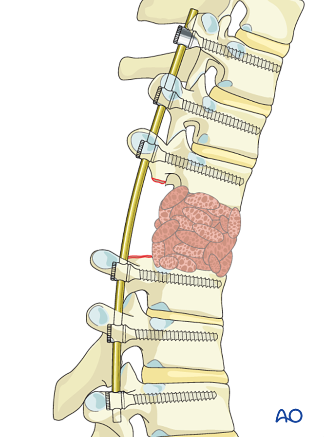 En bloc resection of an anterior tumor (T1 to T12) for Malignant ...