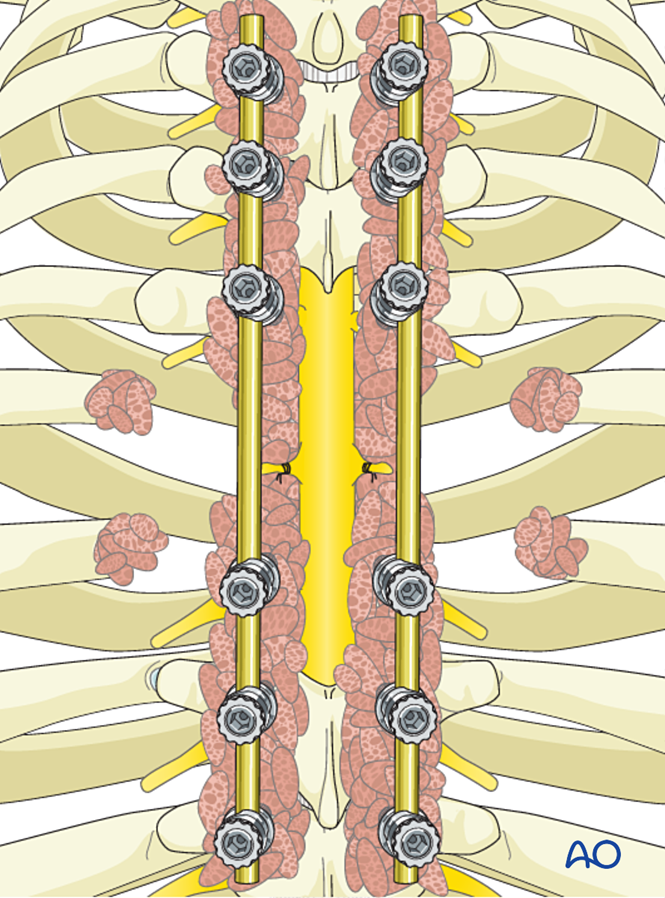 En bloc resection of an anterior tumor (T1 to T12) for Benign thoracic ...