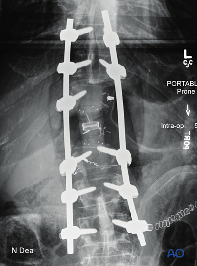 En bloc resection of an anterior tumor (T1 to T12) for Malignant ...