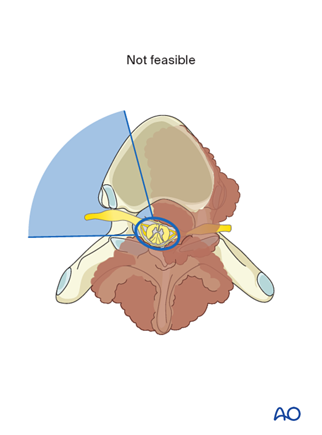 En bloc resection of a posterior tumor (T1 to T12) for Benign thoracic ...