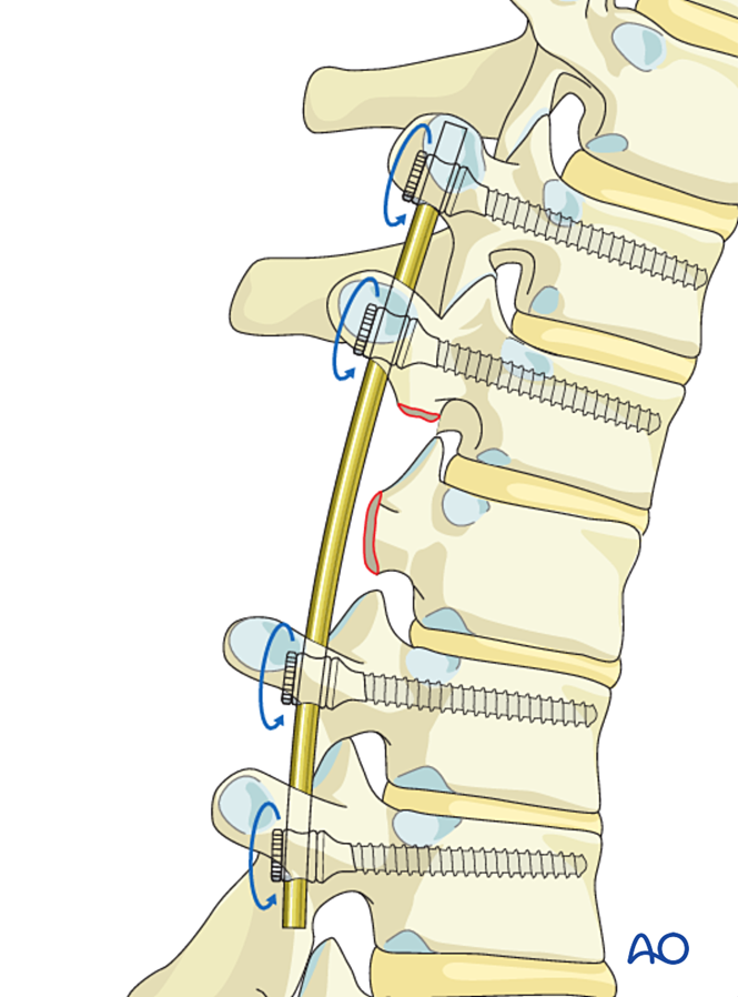 En bloc resection of a posterior tumor (T1 to T12) for Malignant ...