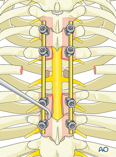 En bloc resection of a posterior tumor (T1 to T12) for Malignant ...